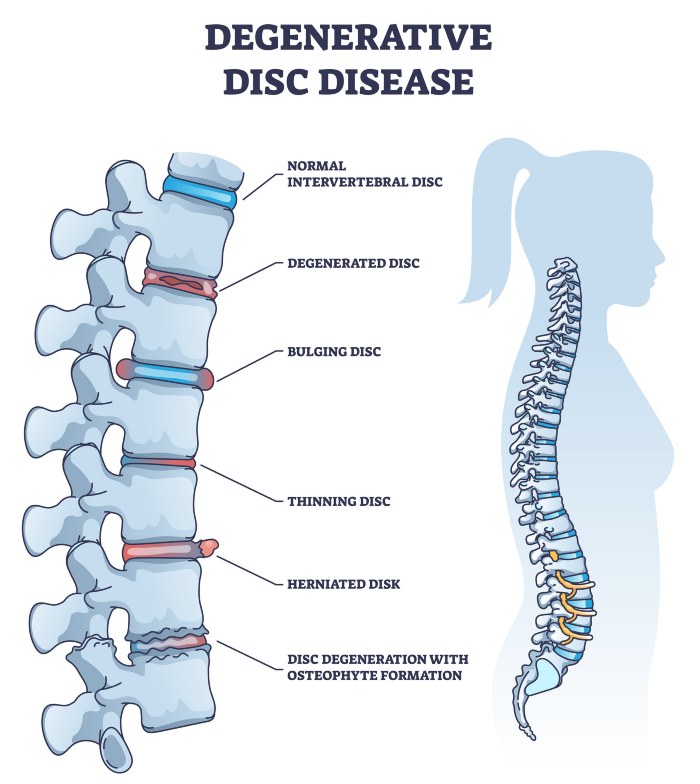 Stages of Degenerative Disc Disease Explained